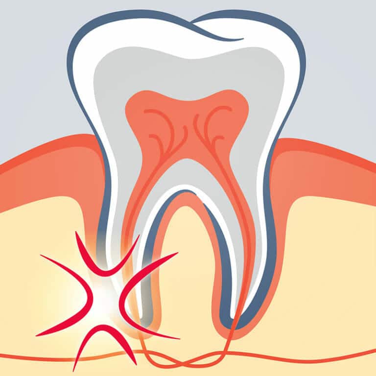 680 Root Canal Illustrations Royalty Free Vector Graphics And Clip Clip Art Library