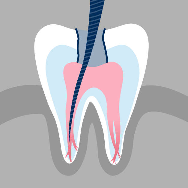 Root Canal Treatment Clip Art Library 3856729